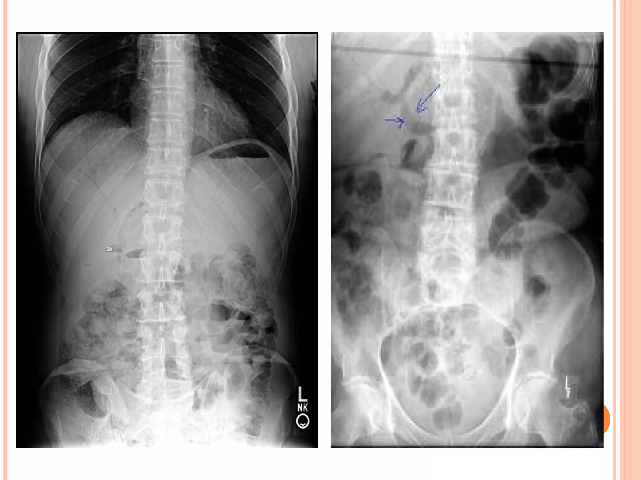 Pneumobilia vs portal vein gas | PPT