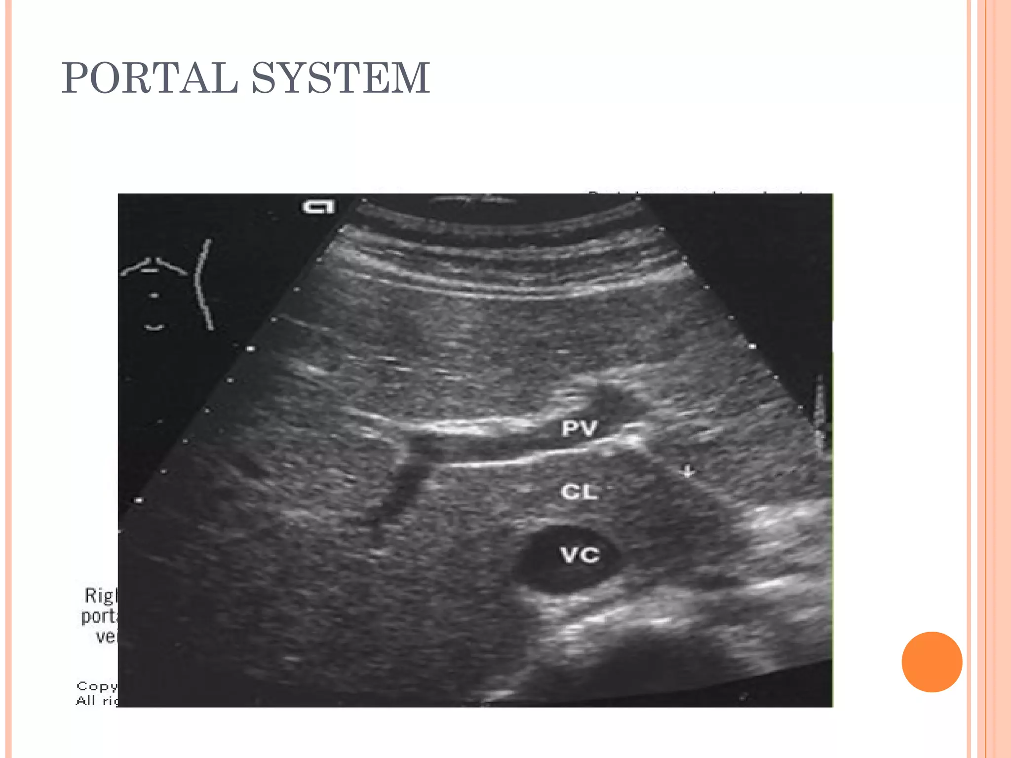 Pneumobilia vs portal vein gas | PPT