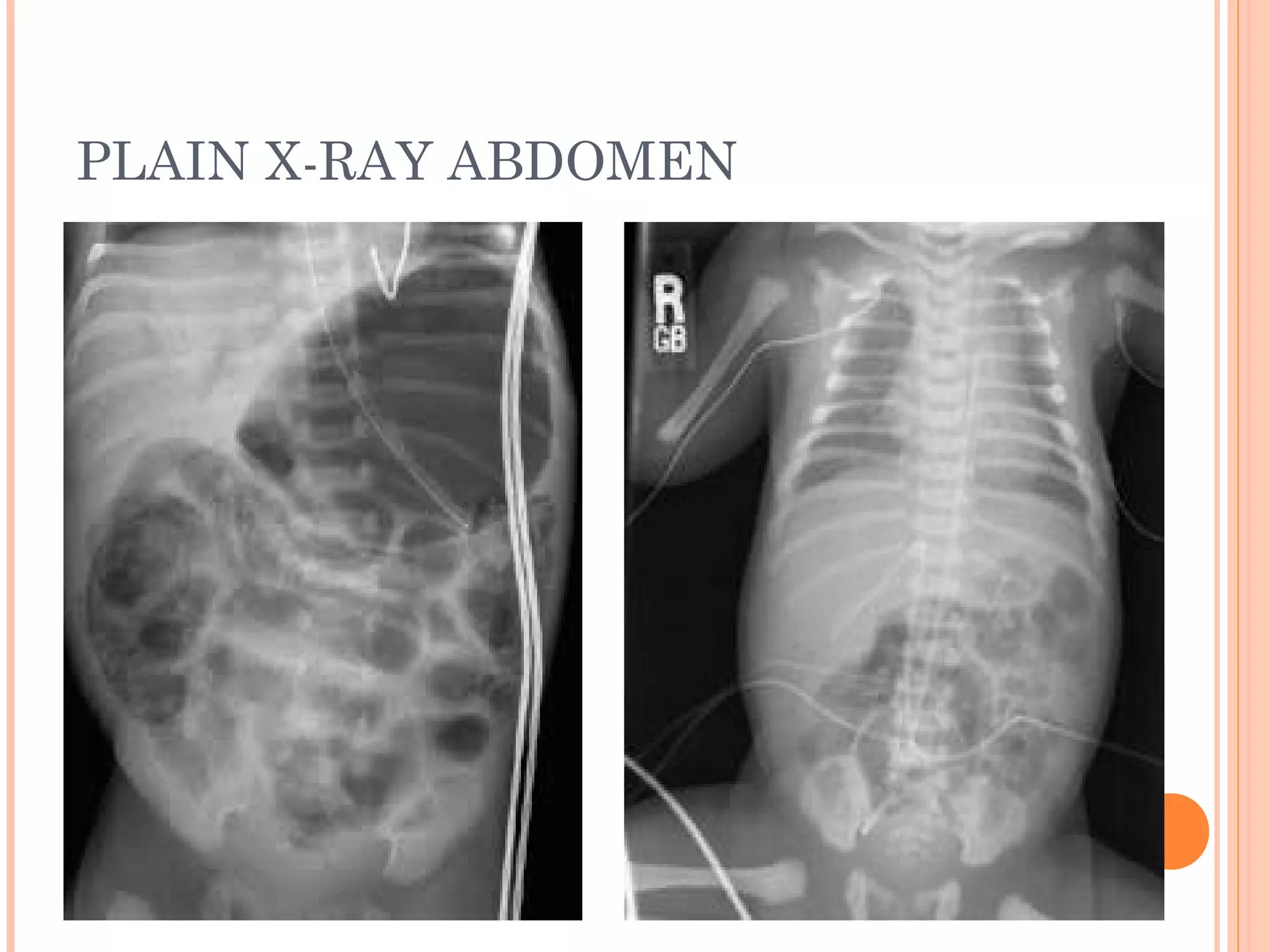 Pneumobilia vs portal vein gas | PPT