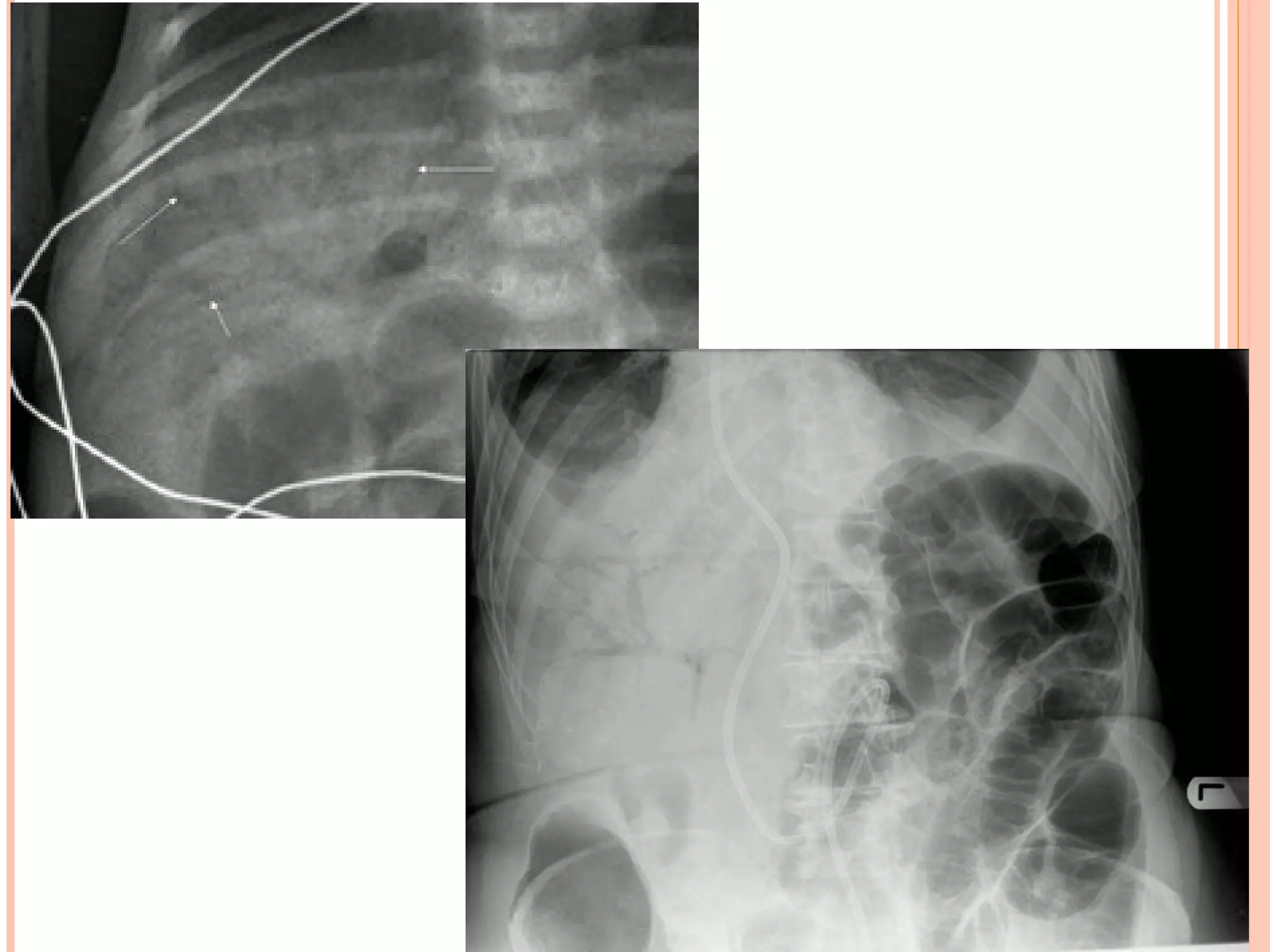 Pneumobilia vs portal vein gas | PPT