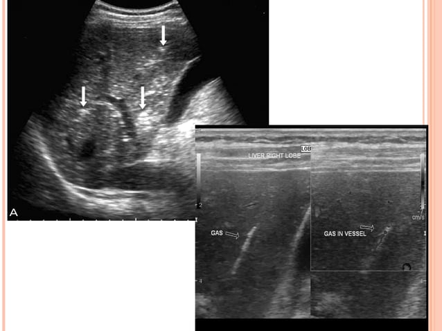 Pneumobilia vs portal vein gas