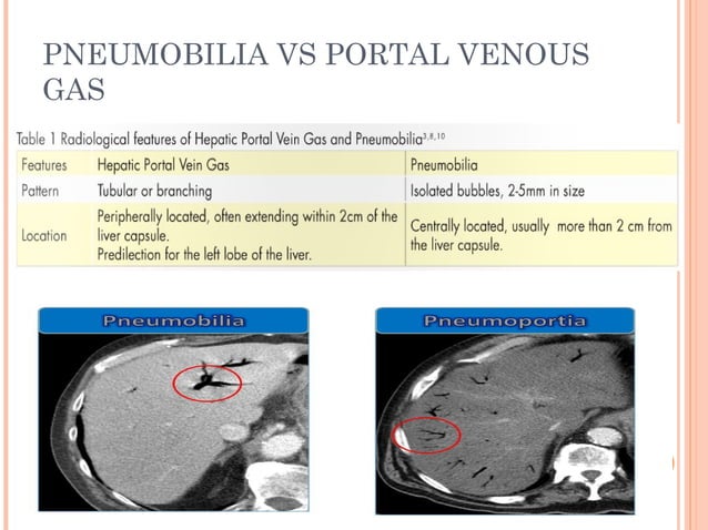 Pneumobilia vs portal vein gas