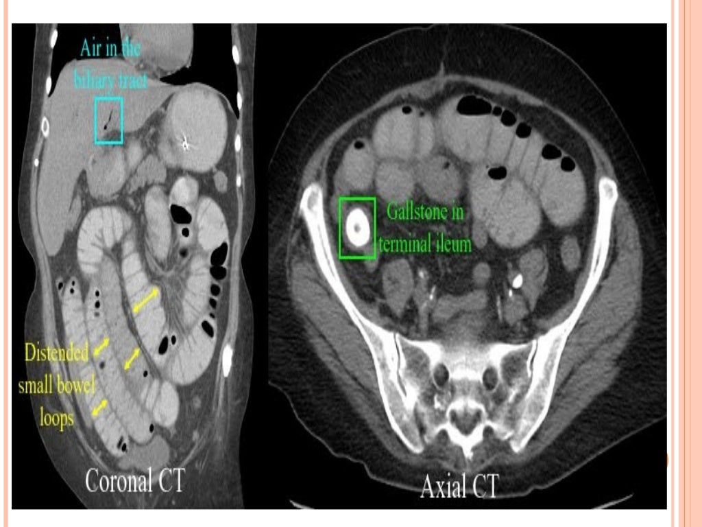 Pneumobilia Vs Portal Vein Gas