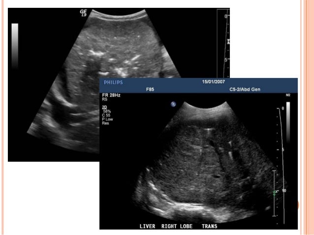 Pneumobilia vs portal vein gas