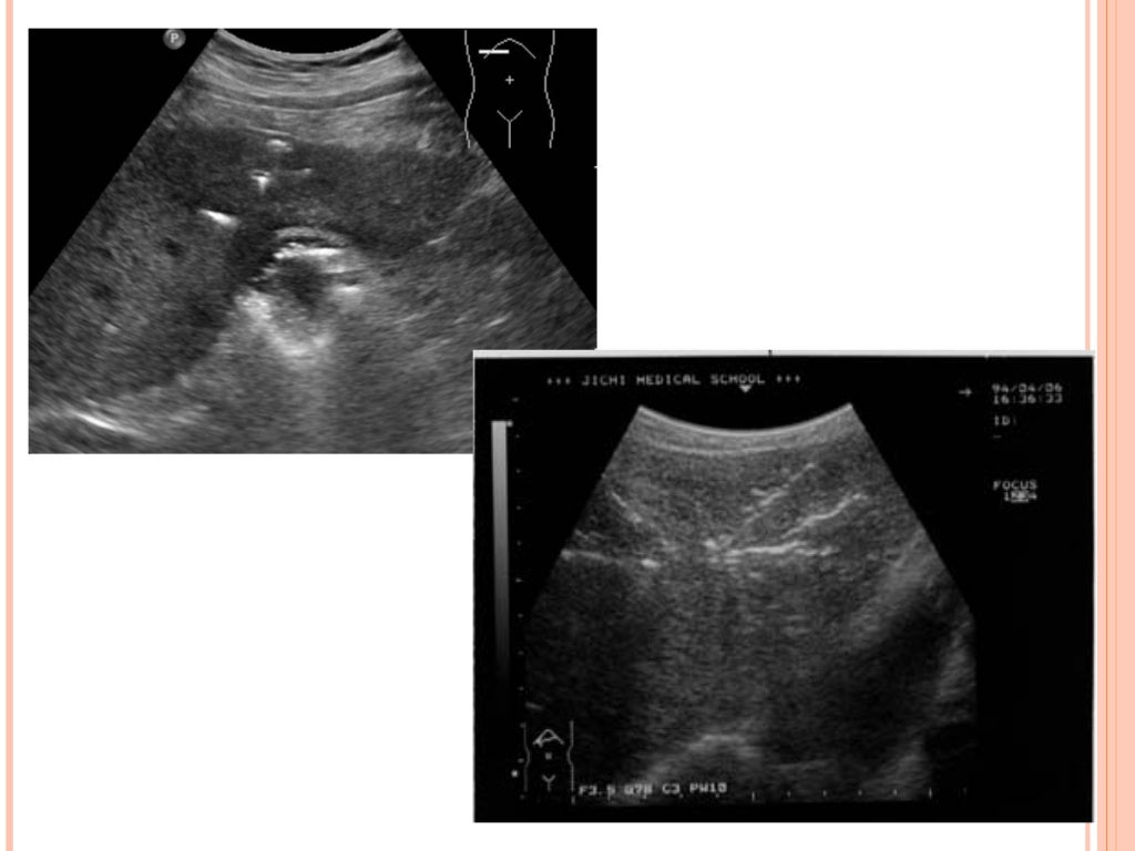Pneumobilia vs portal vein gas