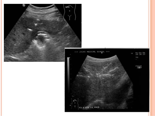 Pneumobilia Vs Portal Vein Gas