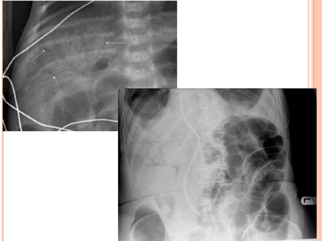 Pneumobilia Vs Portal Vein Gas