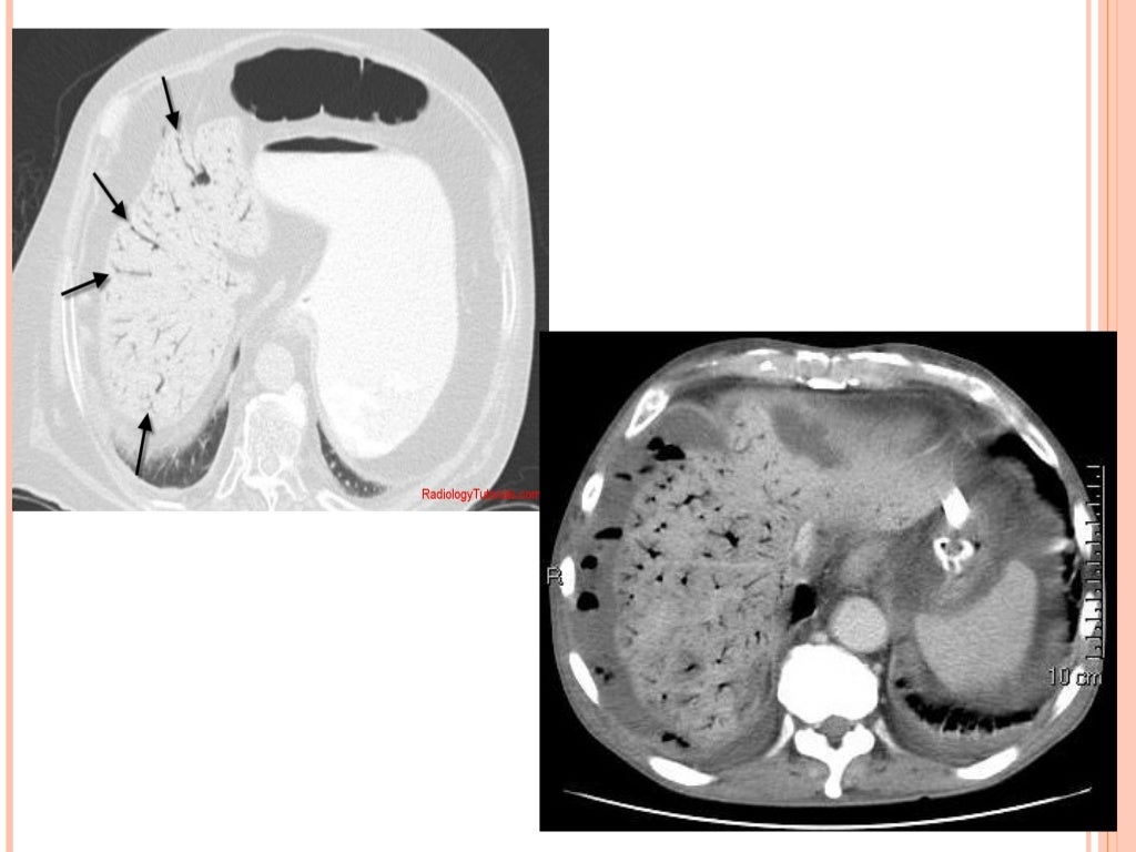 Pneumobilia Vs Portal Vein Gas