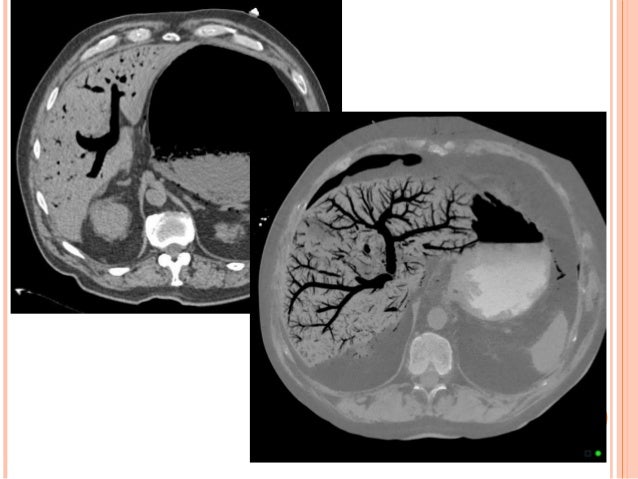Pneumobilia vs portal vein gas