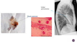 Pneumococcus | PPTX
