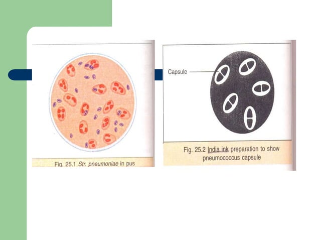 Pneumococcus | PPT | Lung and Respiratory Health | Diseases and Conditions