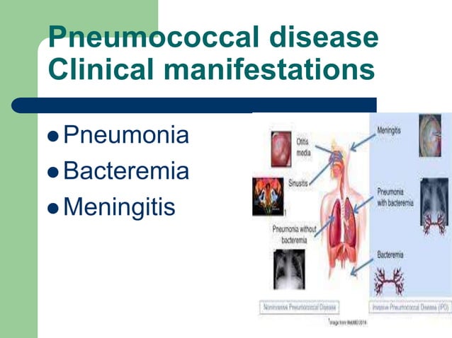 Pneumococcus.ppt
