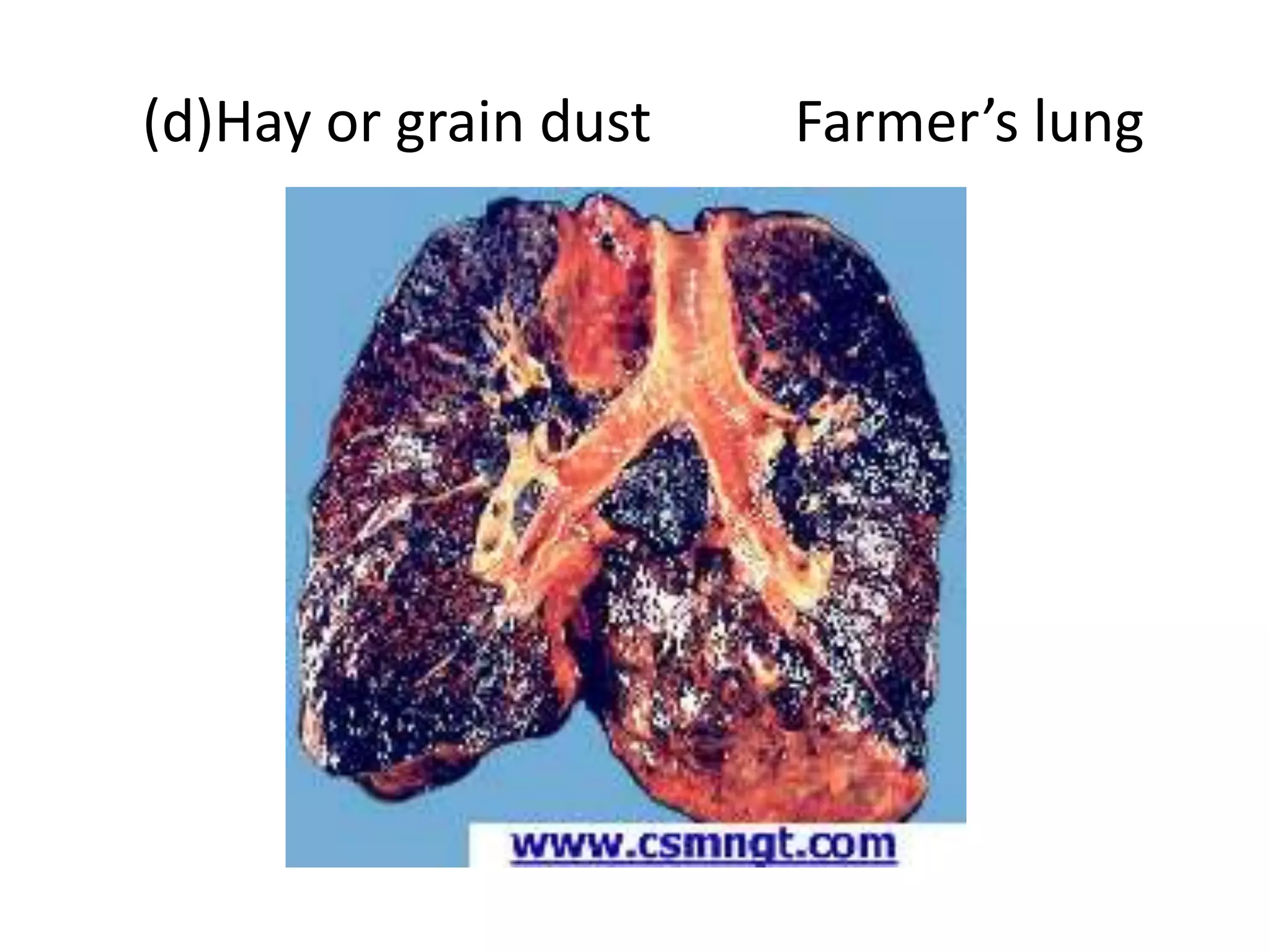 Pneumoconiosis | PPTX