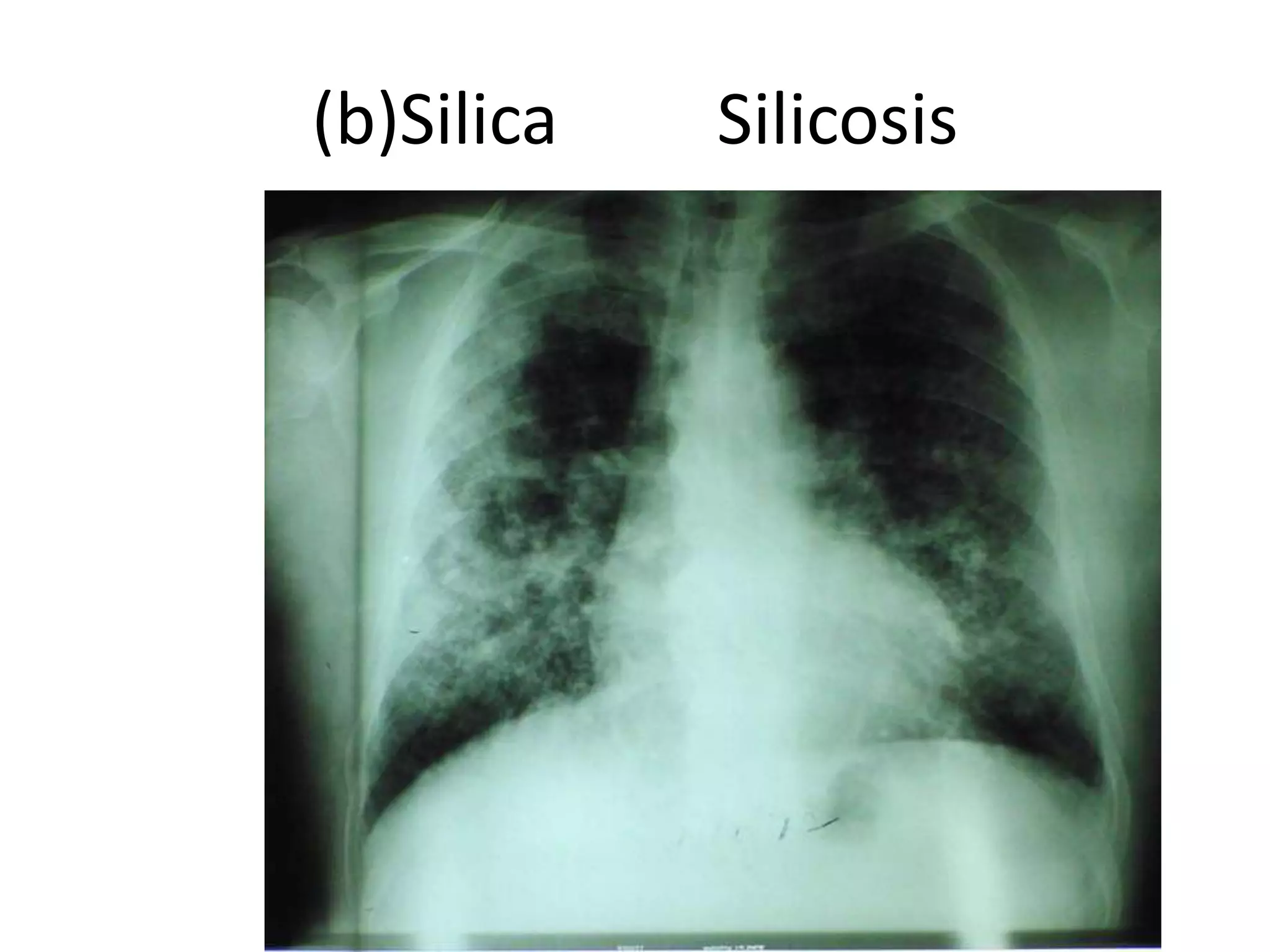 Pneumoconiosis | PPTX