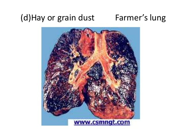 Pneumoconiosis