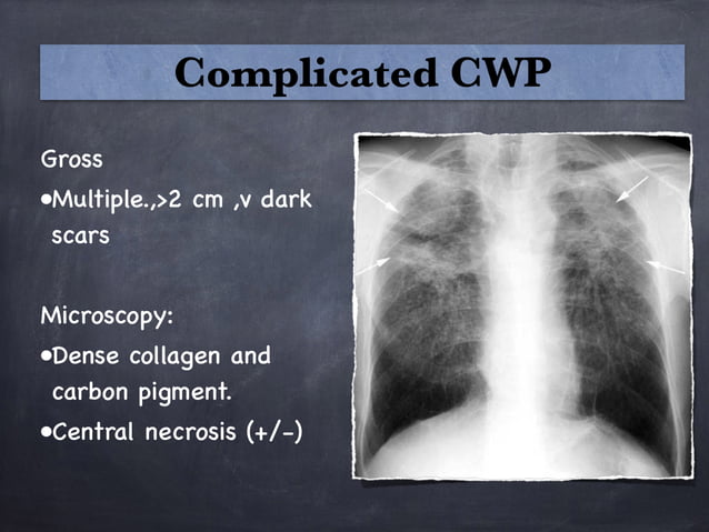 Pneumoconiosis | PDF | Lung and Respiratory Health | Diseases and ...