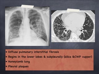 Pneumoconiosis | PDF