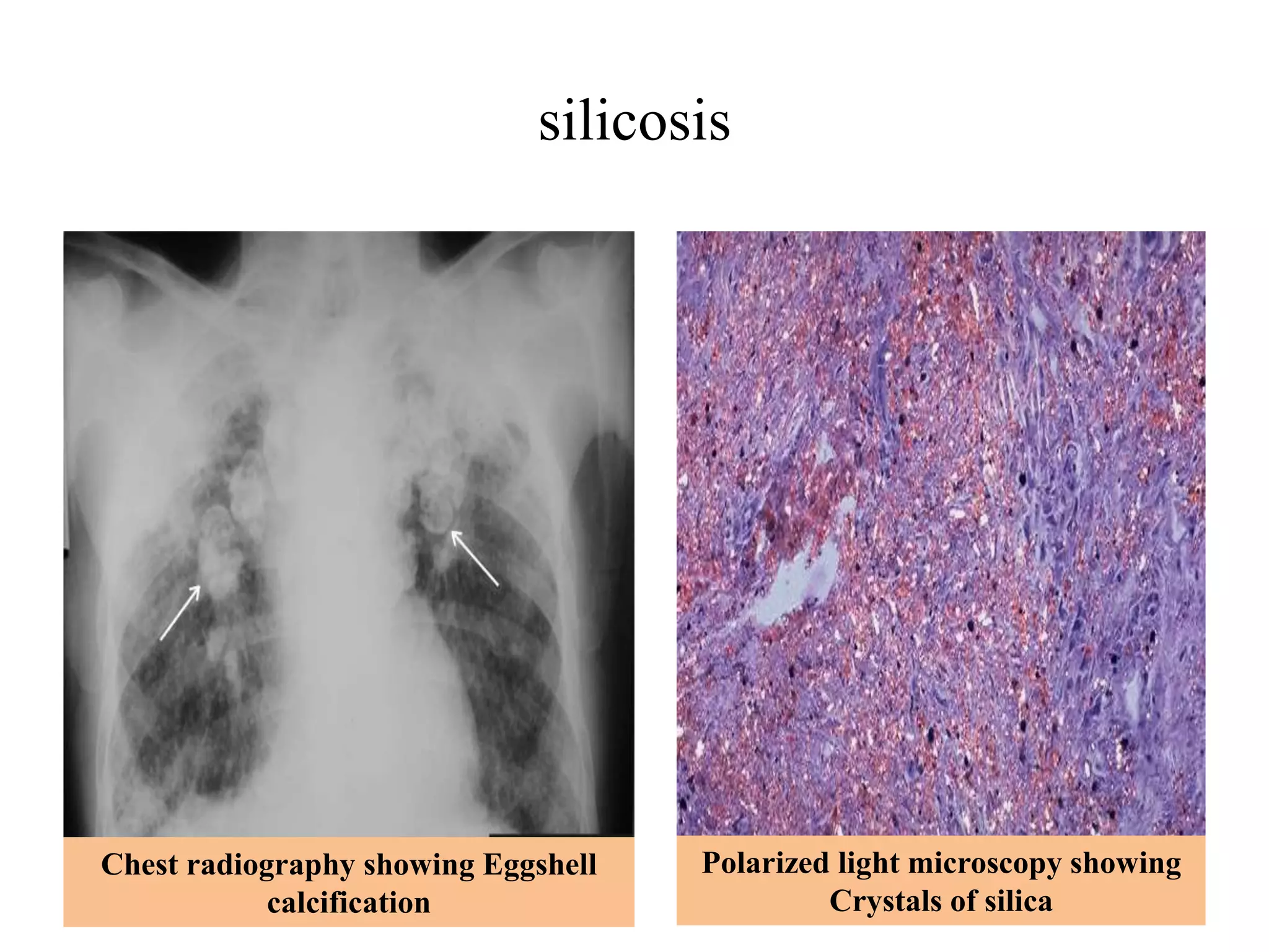Pneumoconiosis | PPTX
