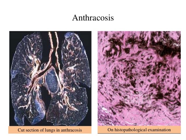 Pneumoconiosis