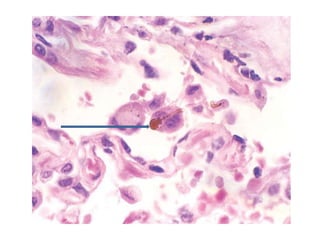 Pneumoconiosis | PPTX