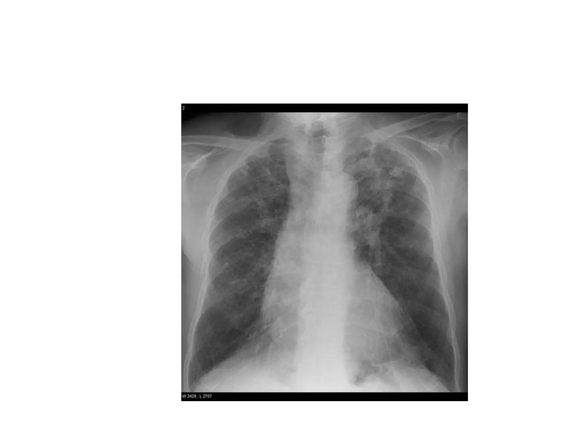 Pneumoconiosis | PPTX