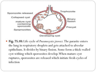 Pneumocystis jirovecii infection | PDF