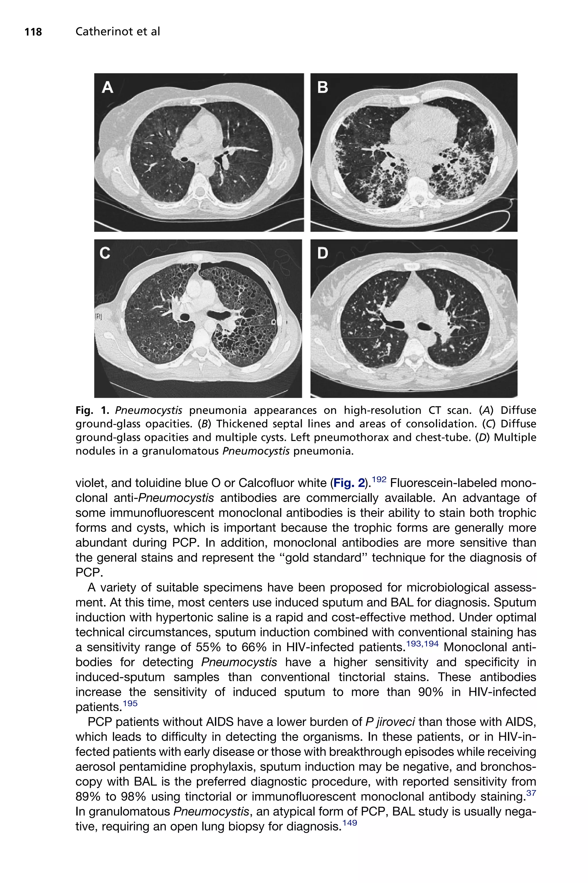 Pneumocystis jirovecii pneumonia | PDF