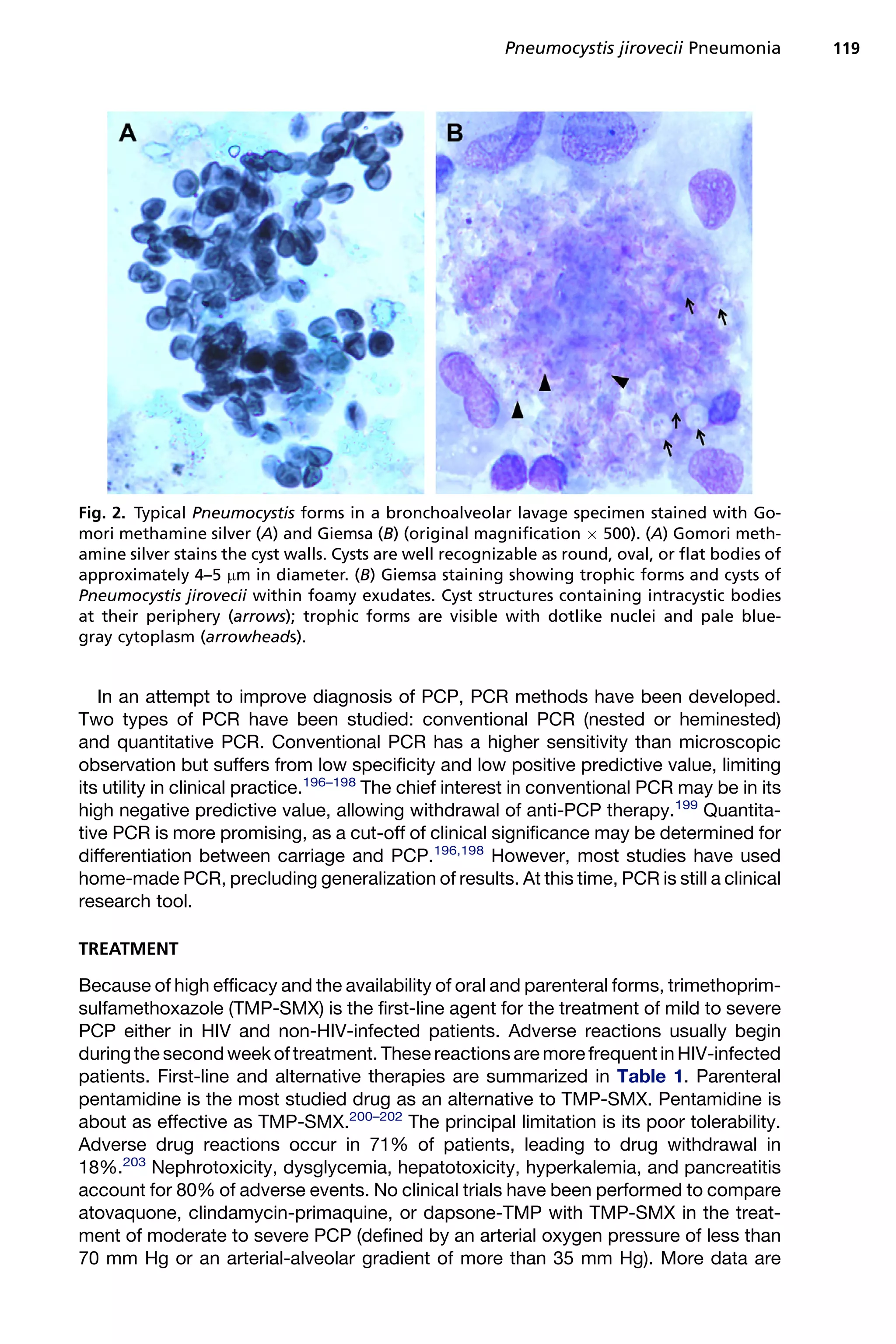 Pneumocystis jirovecii pneumonia | PDF