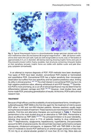 Pneumocystis jirovecii pneumonia | PDF