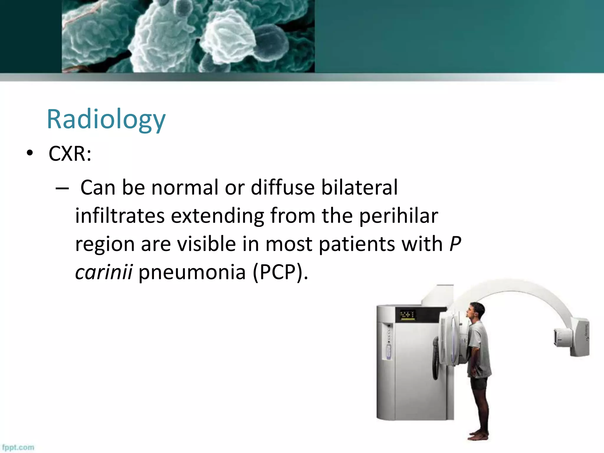 Pneumocystis Pneumonia | PPTX