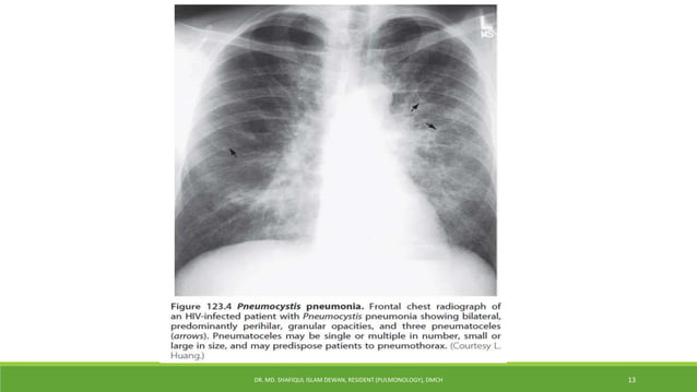 Pneumocystis Pneumonia.pptx | Lung and Respiratory Health | Diseases ...