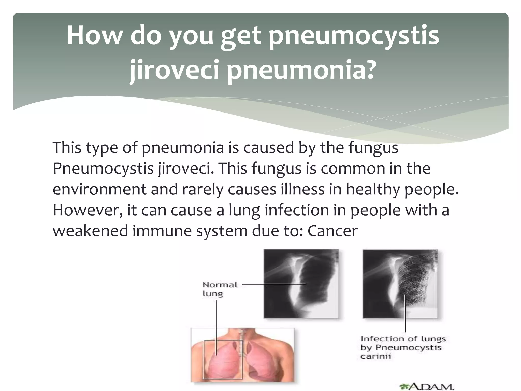 pneumocytis pneumonia.pptx (4).pptx