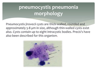 pneumocytis pneumonia.pptx (4).pptx