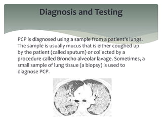 pneumocytis pneumonia.pptx (4).pptx