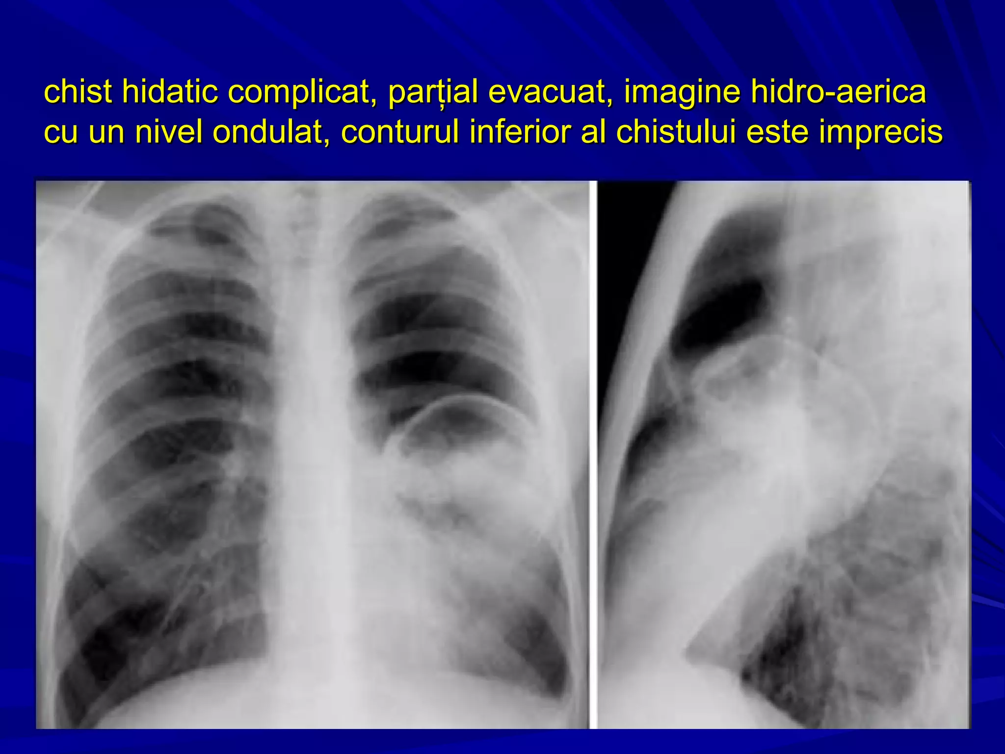 Pneumologie - chistul hidatic | PPT