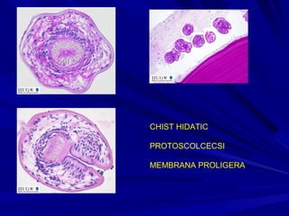 Pneumologie - chistul hidatic | PPT