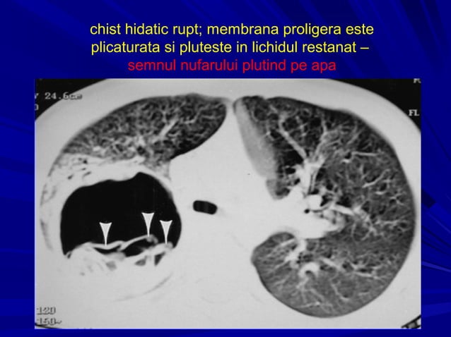 Pneumologie - chistul hidatic | PPT