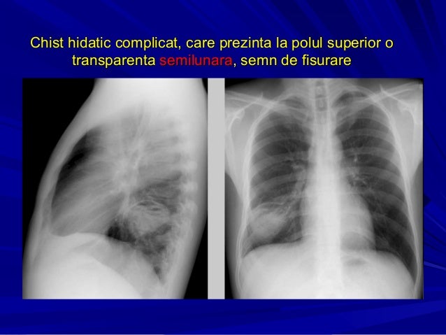 Pneumologie - chistul hidatic