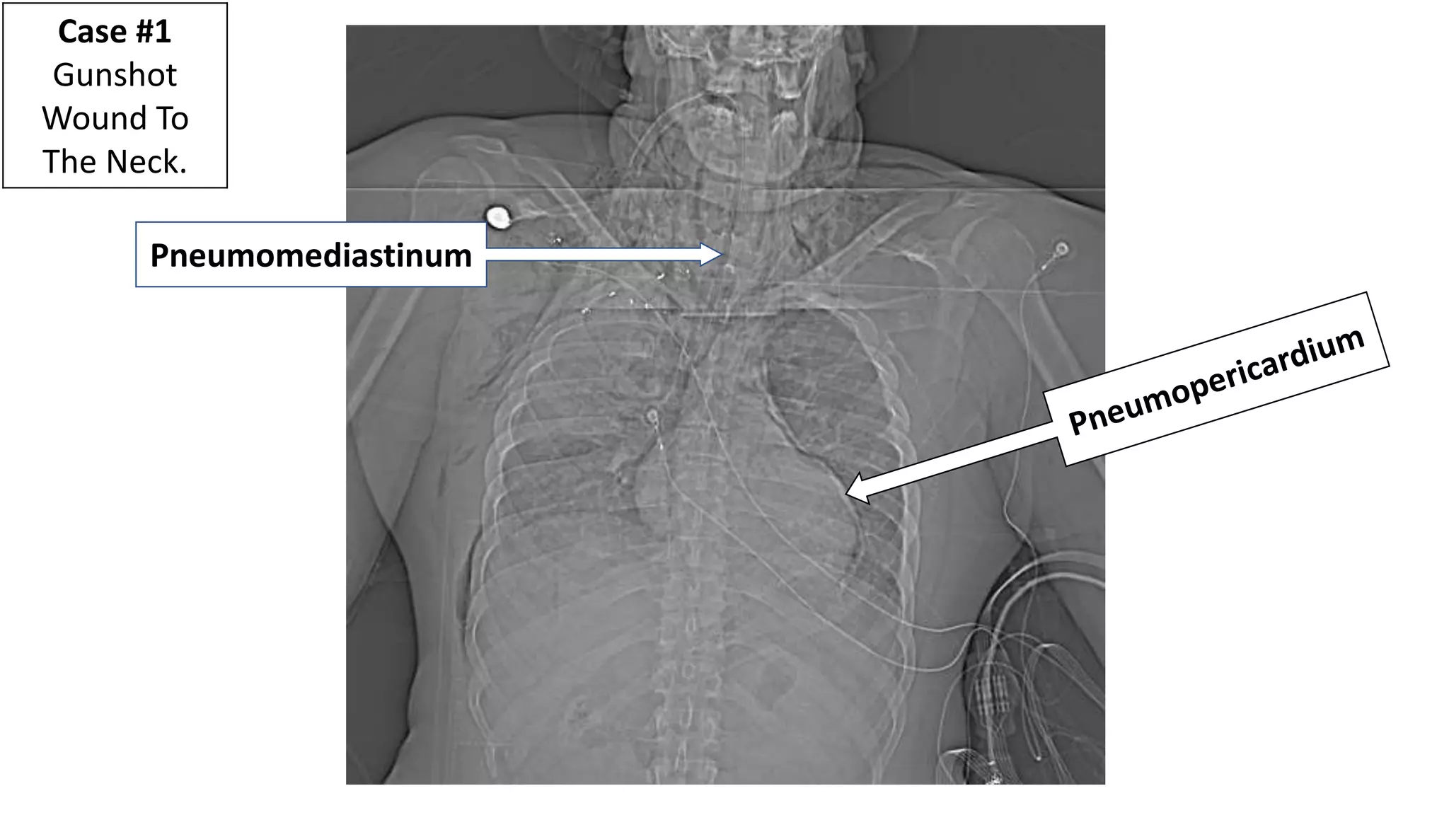 EMGuideWire's Radiology Reading Room: Pneumomediastinum | PPTX | Lung ...