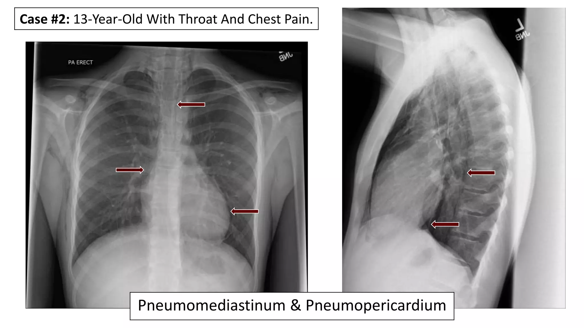 EMGuideWire's Radiology Reading Room: Pneumomediastinum | PPTX | Lung ...