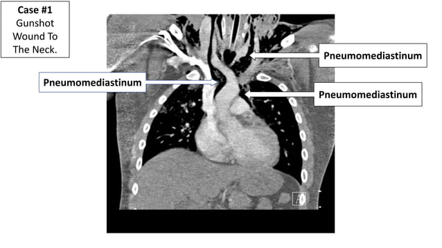 EMGuideWire's Radiology Reading Room: Pneumomediastinum | PPTX | Lung ...