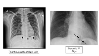 EMGuideWire's Radiology Reading Room: Pneumomediastinum | PPT