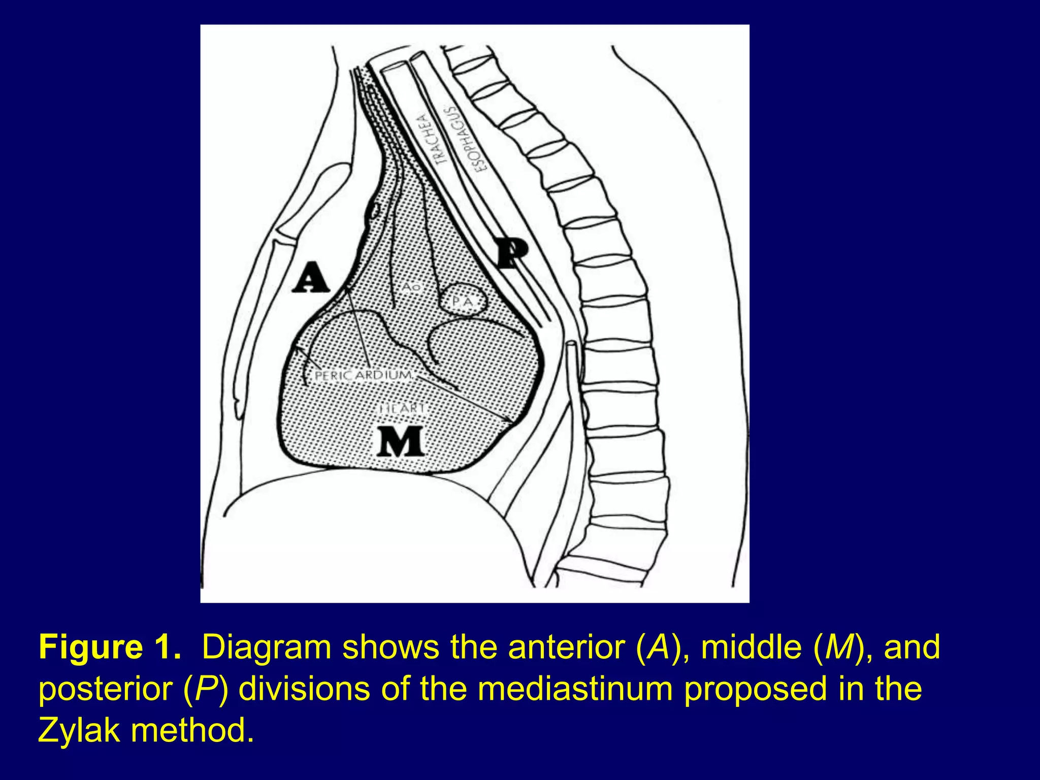 Pneumomediastinum | PPTX