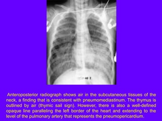 Pneumomediastinum | PPTX