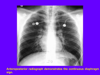 Pneumomediastinum | PPTX