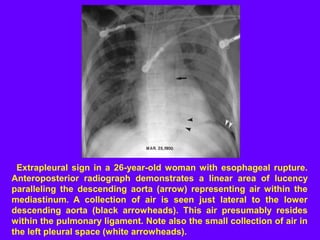Pneumomediastinum | PPTX