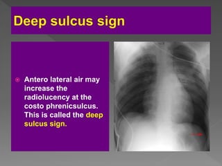 Pneumomediastinum | PPTX