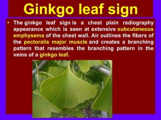 Pneumomediastinum | PPTX