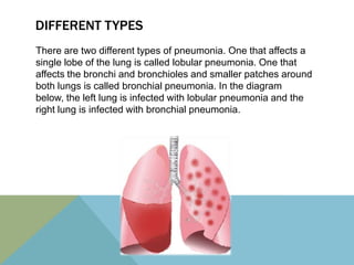 Pneumonia | PPTX