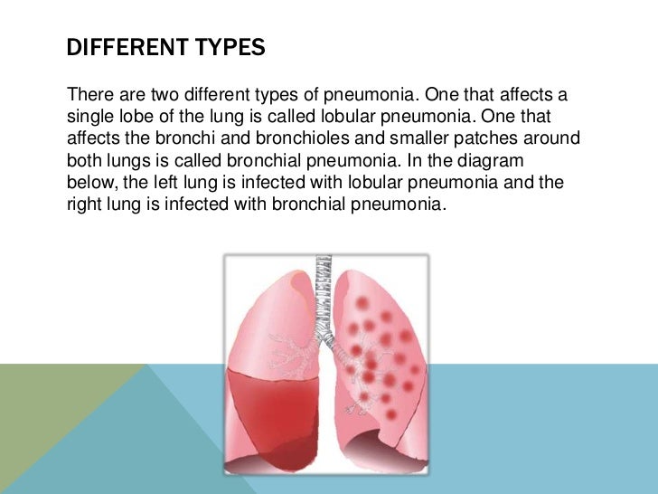 Pneumonia Pneumonia